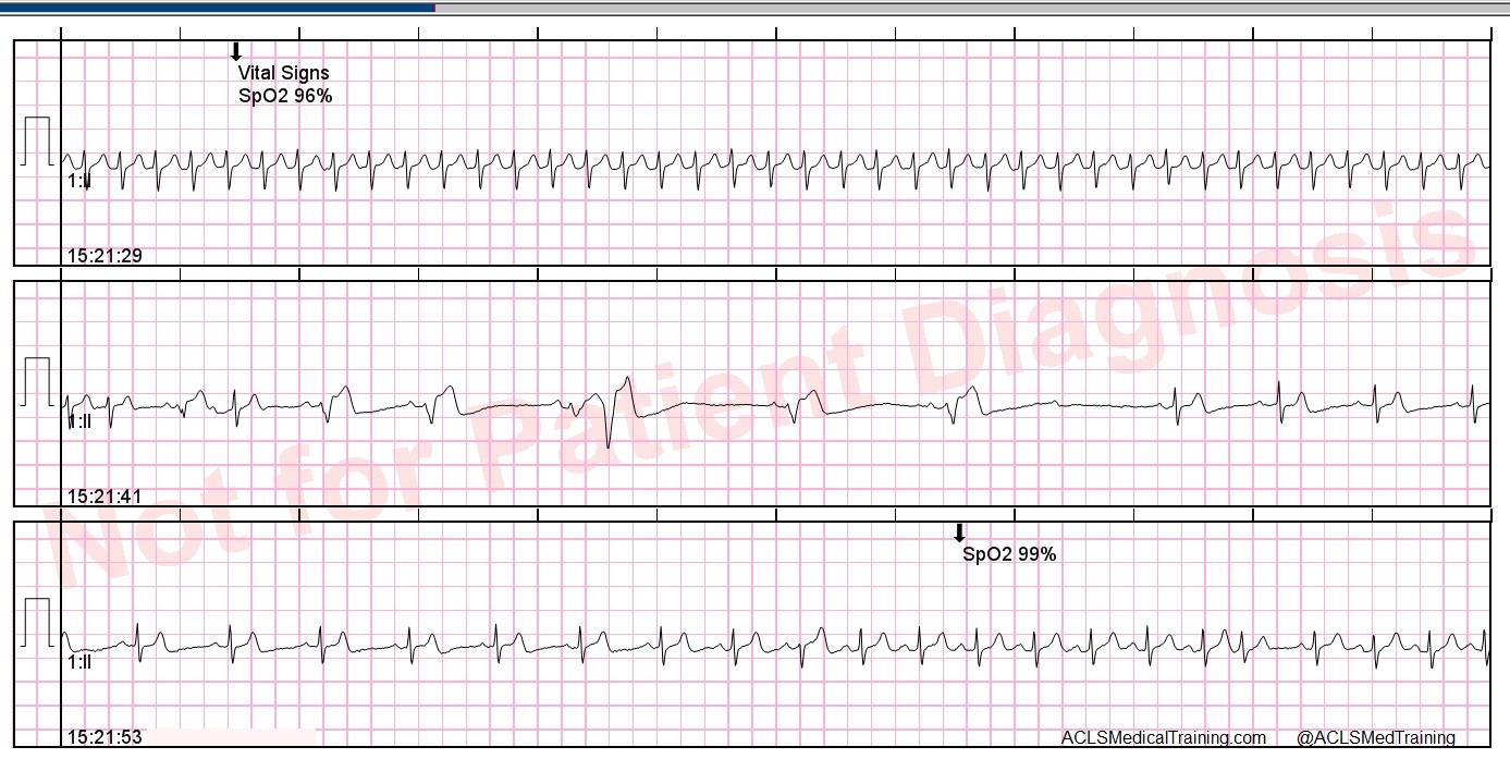 Treating Supraventricular Tachycardia with Adenosine