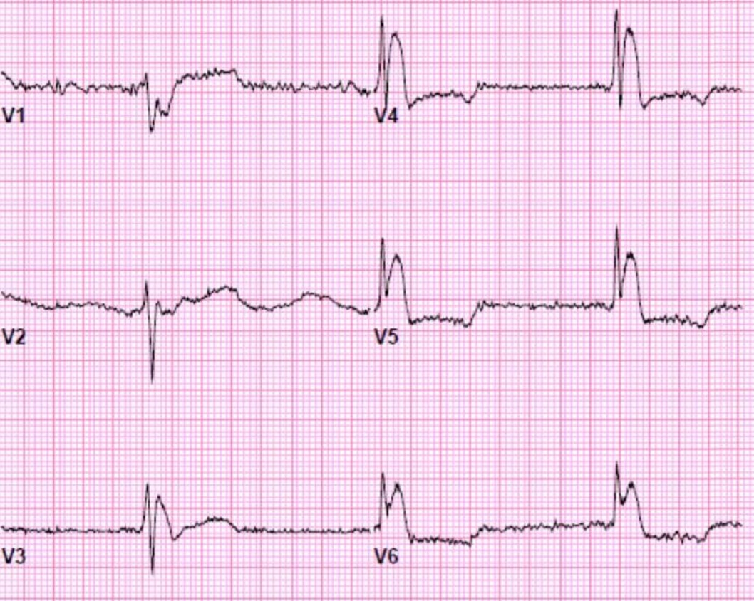 55 year old male with altered mental status, hypothermia, and Osborn waves - ACLS Medical Training